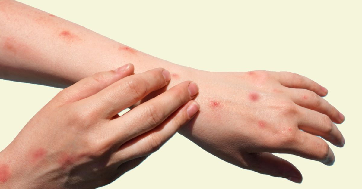 Monkeypox Symptoms, Causes, & Prevention Demystified - SaziBox Health
